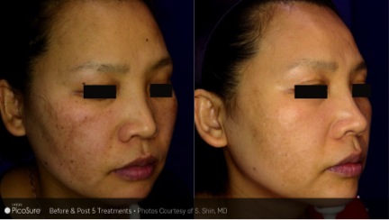 what-are-the-best-treatments-for-hyperpigmentation-on-asian-skin