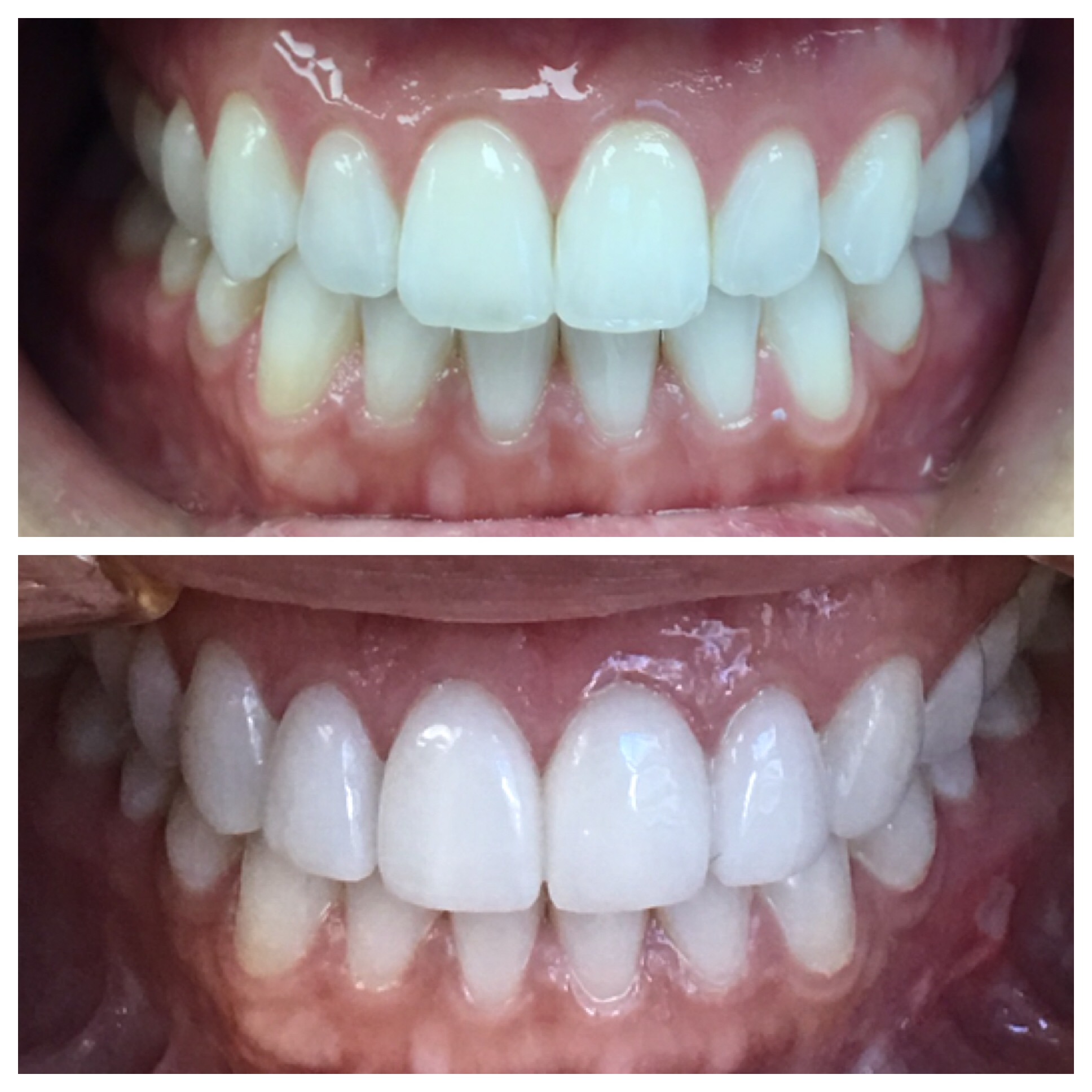 Dr. Victoria Veytsman: Porcelain Veneers Mimic A Natural Smile To ...