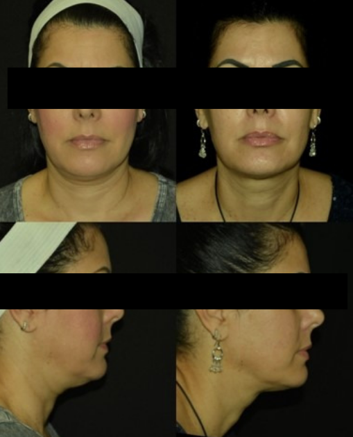 4 Effective Ways To Fight Neck Aging - Haute Beauty by Haute Living