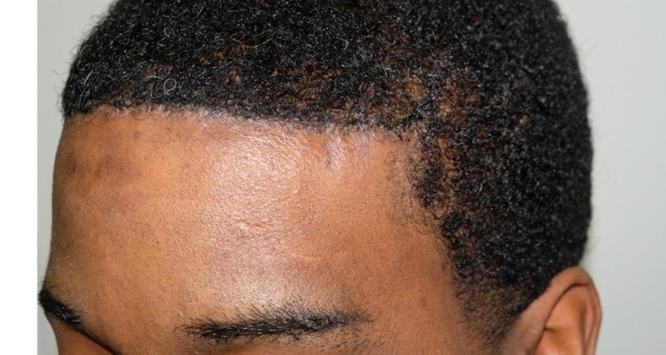 Dr. Gary Linkov Dishes On How He Treats a High Hairline