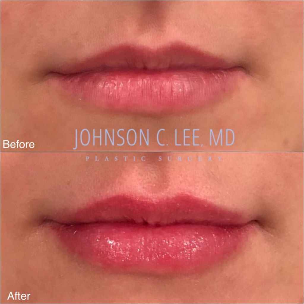 Seeking More Voluminous Lips? Here's The Process