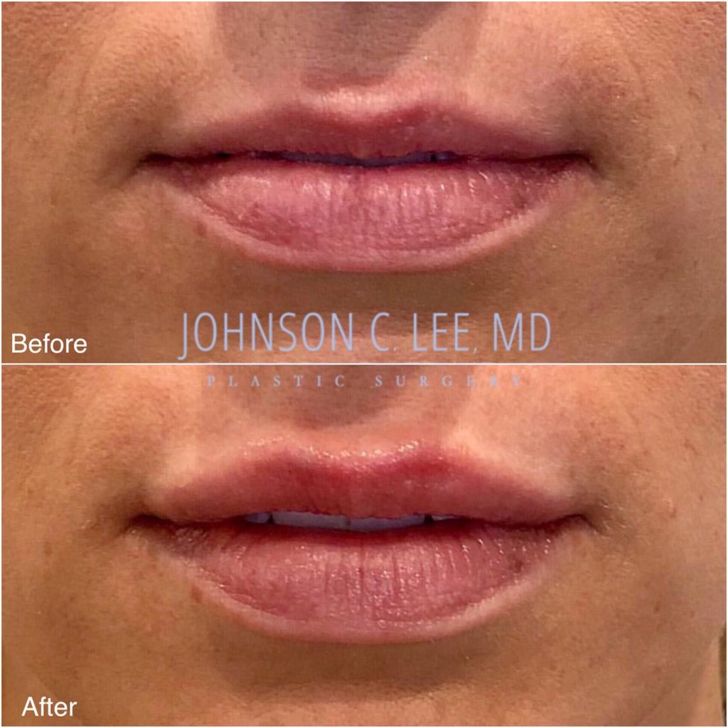 Seeking More Voluminous Lips? Here's The Process