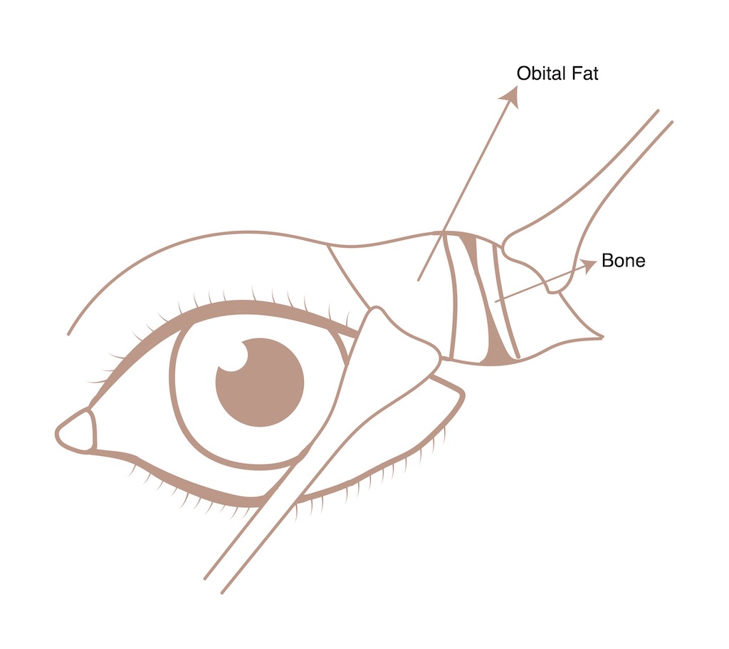 Orbital Decompression Will Reduce Your Eyeballs Large Appearance With ...