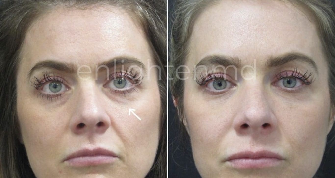 How To Achieve A Natural Look With Fillers According To Enlighten MD