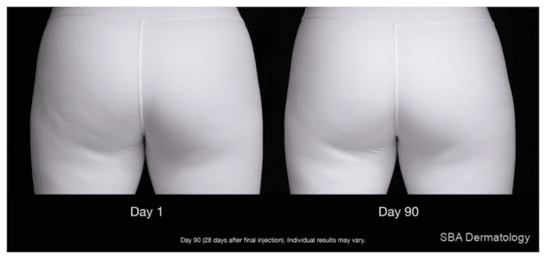 What Is QWO And How Does It Remove Cellulite?