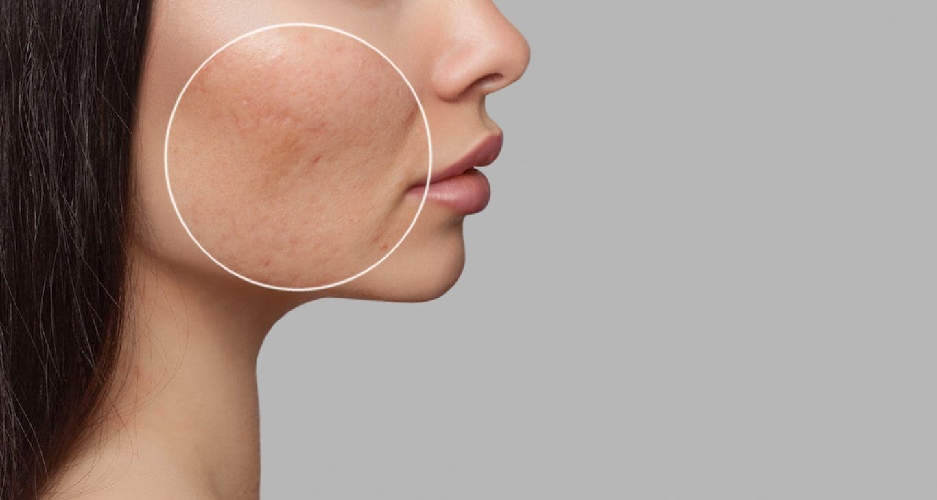 Skin Resurfacing Therapy: Tips, Treatments, & Benefits