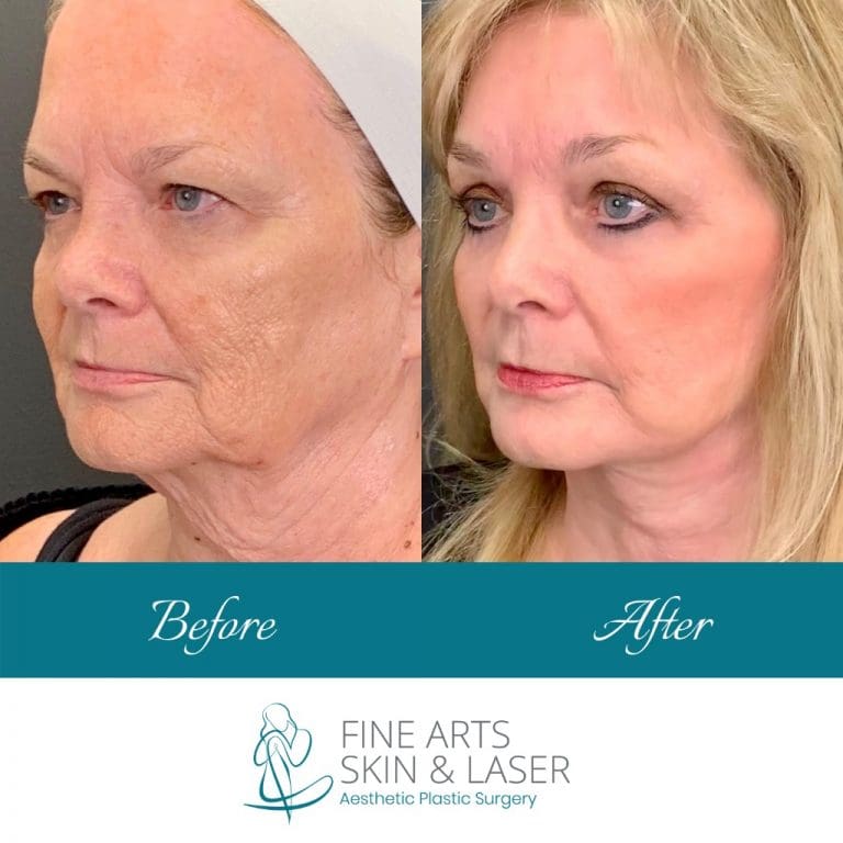 Living-Fat Transfers & Liposculpting: Benefits, Procedure, Recovery ...