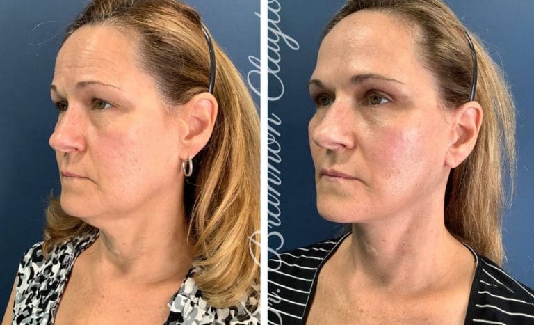Traditional VS Deep Plane: The Differences In Facelift Techniques ...
