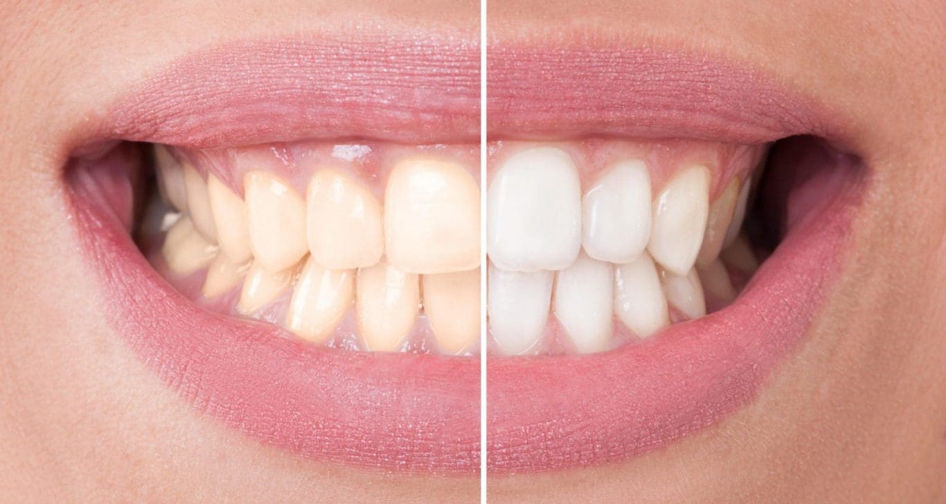 Here’s What To Do If Whitening Strips Are Not Making The Cut - Haute ...