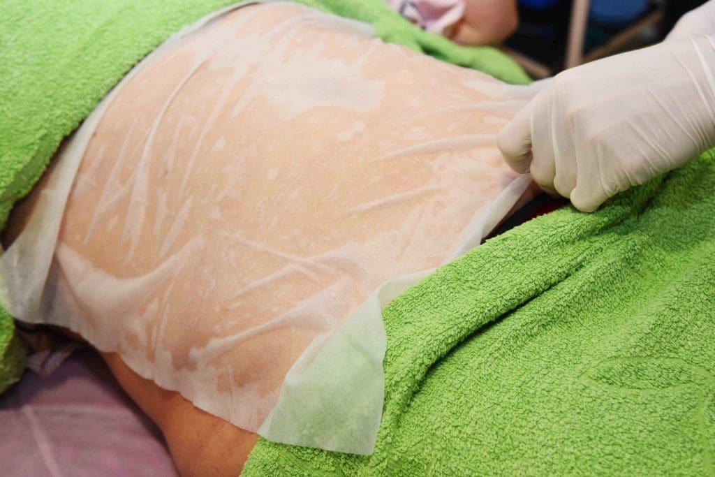 Recognizing The Rarity Of Paradoxical Adipose Hyerplastia (PAH) After ...