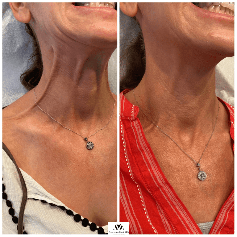 Teeth Grinders, It's Time To Make Your Lower Face Happy With Botox ...