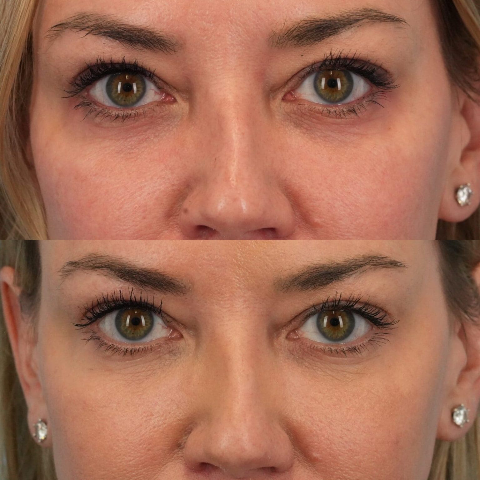 PSA: Dermal Fillers Can Correct The Dark Circles Under Your Eyes