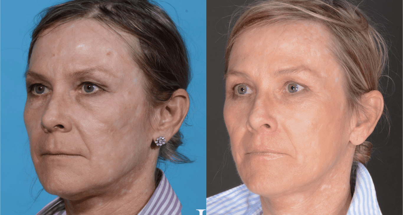 The Details Surrounding Facial Fat Grafting For Facial Contouring