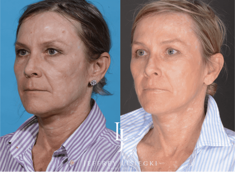 The Details Surrounding Facial Fat Grafting For Facial Contouring