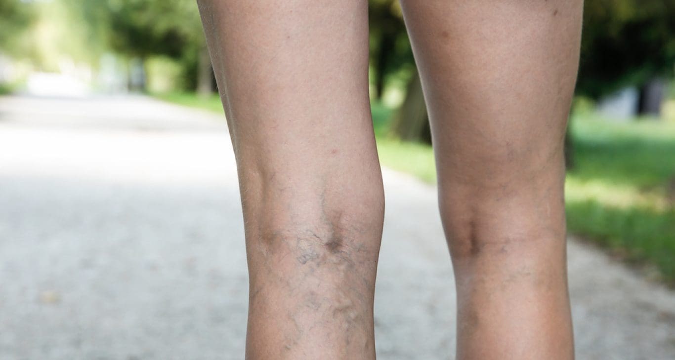 How To Treat Those Unsightly Varicose Veins Running Down Your Legs