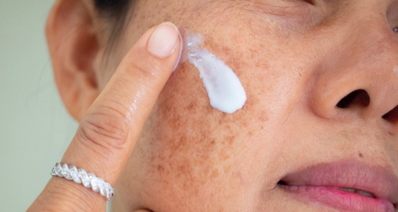 Millennials And Melasma: The Next Big Skin Challenge