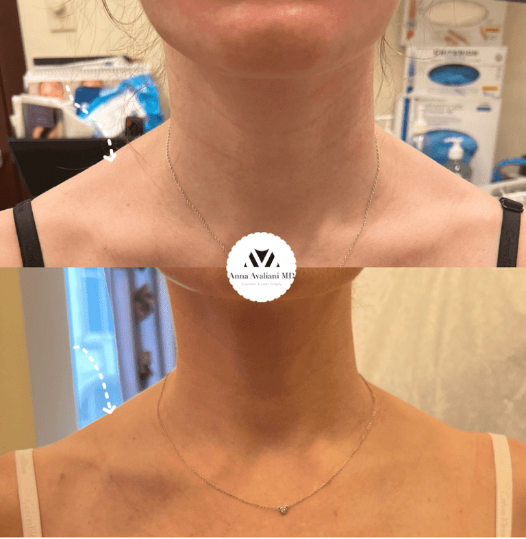 Understanding Then Hype Behind 'TrapTox' For Neck And Shoulder Pain