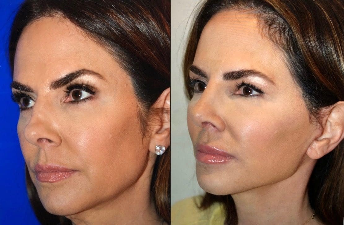 Dr. Sam Rizk's Deep Plane Facelift Revolution: Demystifying Plastic ...