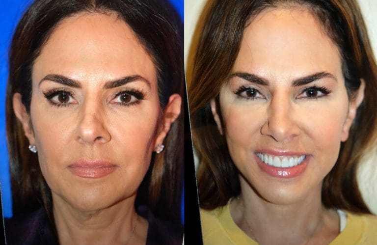 Dr. Sam Rizk's Deep Plane Facelift Revolution: Demystifying Plastic ...
