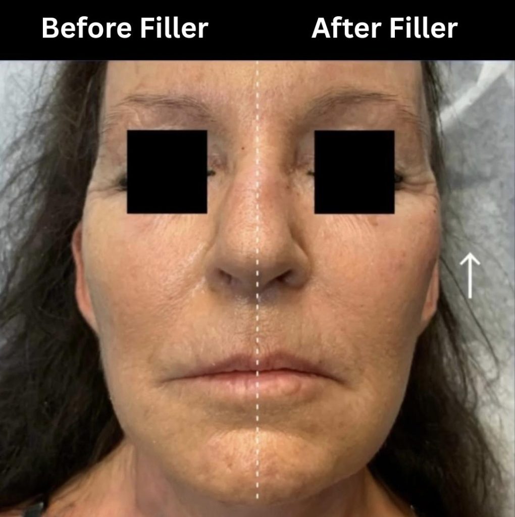 The Art of Fillers: Why Expertise Matters