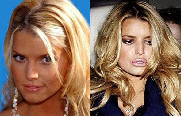 Celebrities: Before and After Plastic Surgery - Haute Living